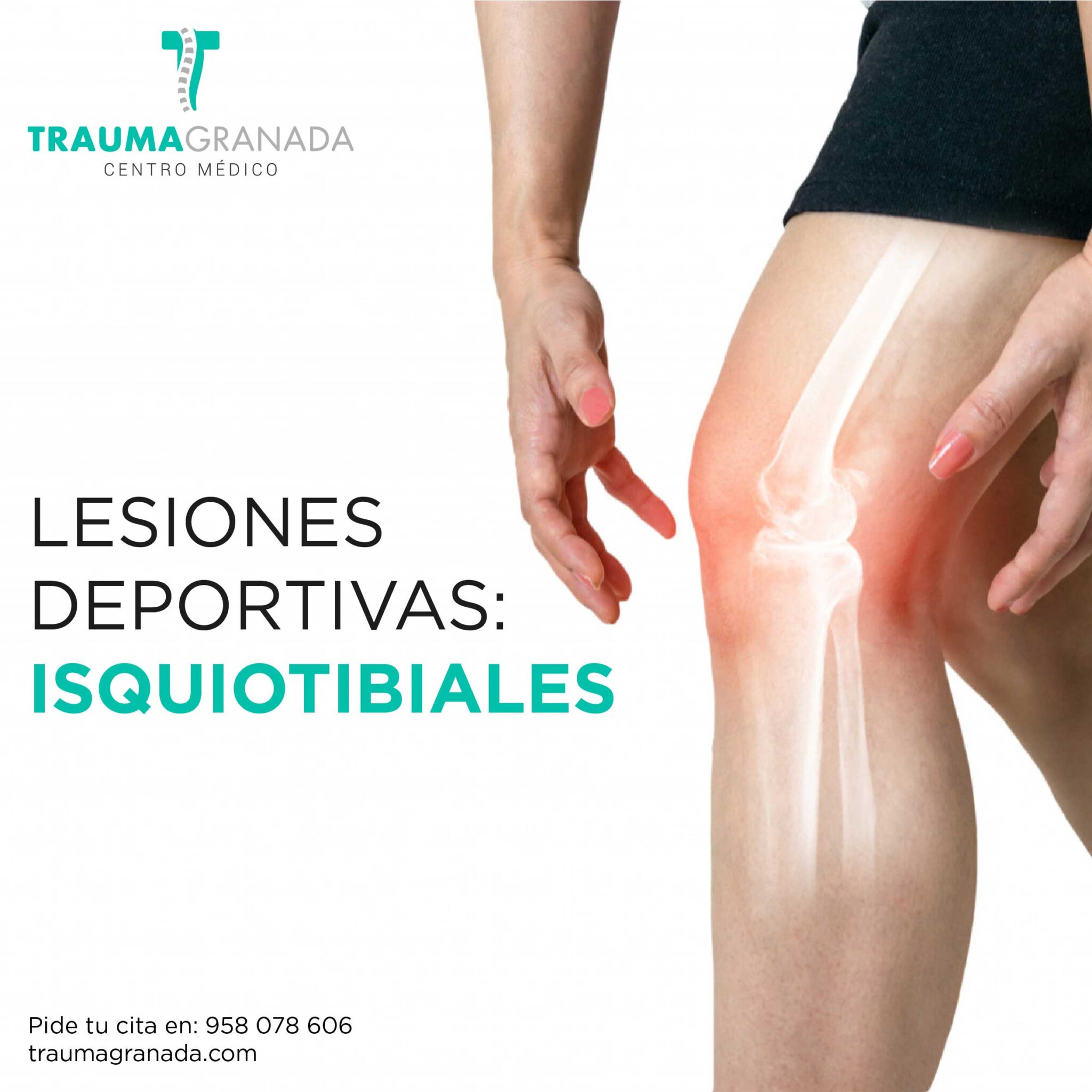 Lesiones deportivas: los isquiotibiales - Trauma Granada