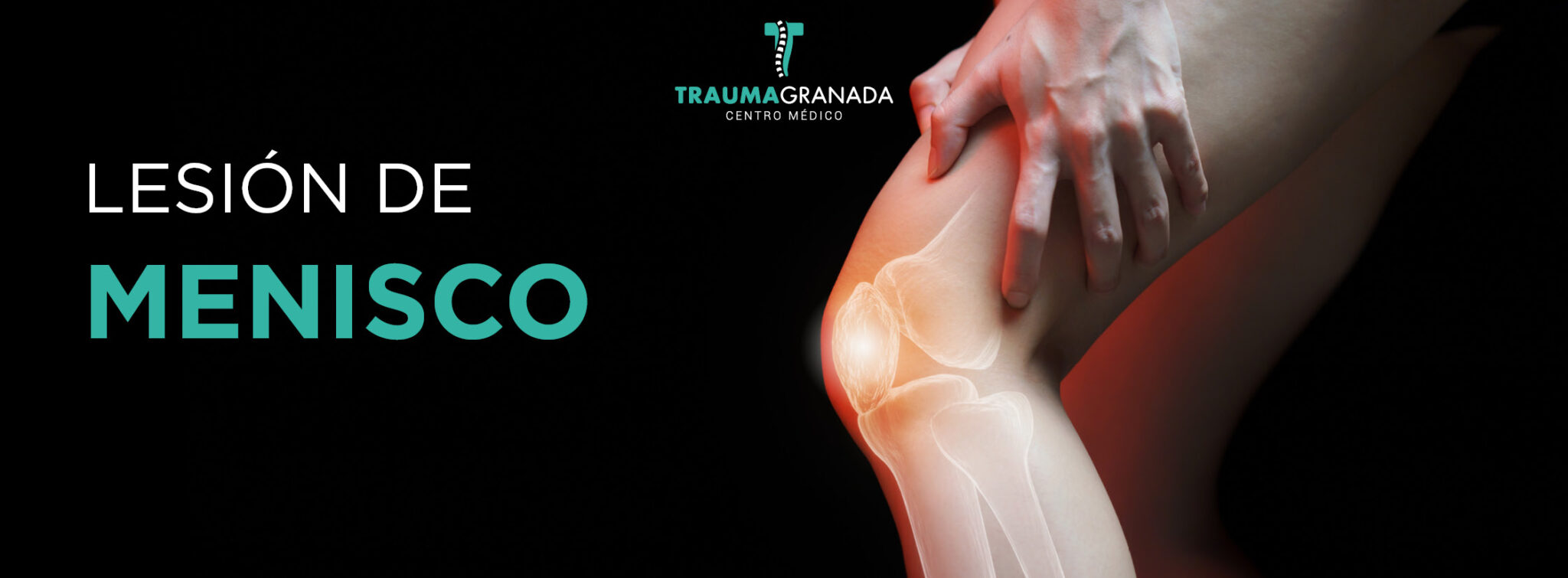 Lesión de menisco - Trauma Granada