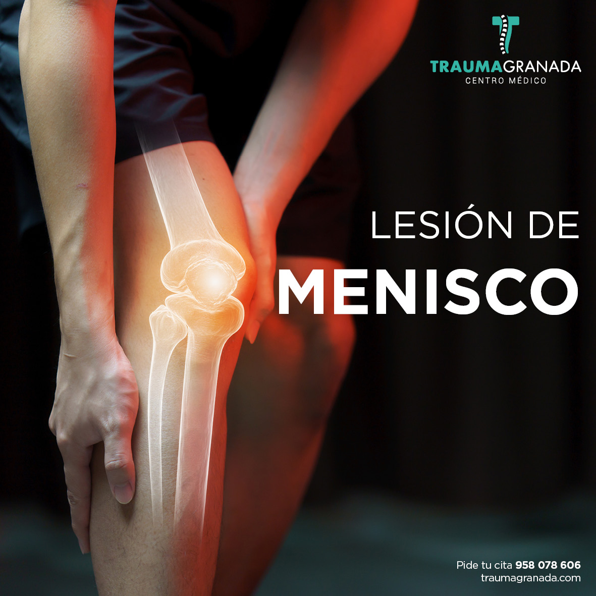 Lesión de menisco - Trauma Granada