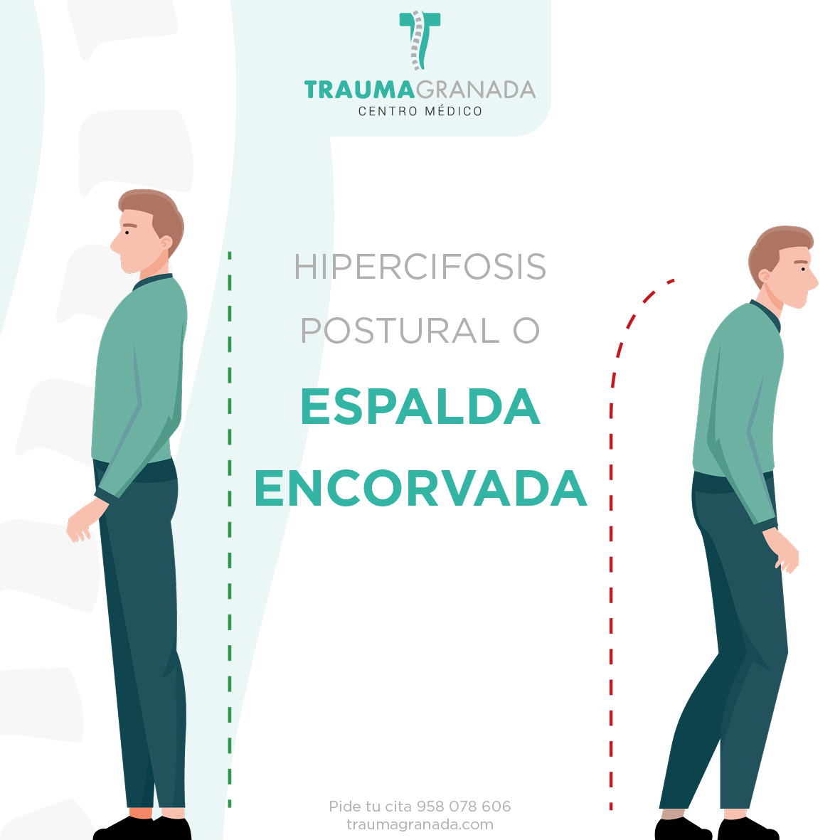 La hipercifosis postural o espalda encorvada - Trauma Granada